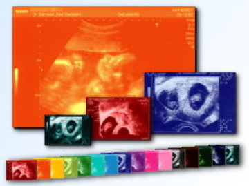 Buy Ultrasound Scan of Your Baby as Colored Art Print Online ...